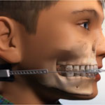 Types of Appliances - Brooklyn NY | Hanson Place Orthodontics