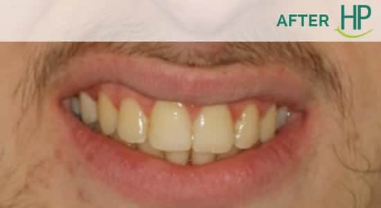 SureSmile® Before and After - Brooklyn NY | Hanson Place Orthodontics