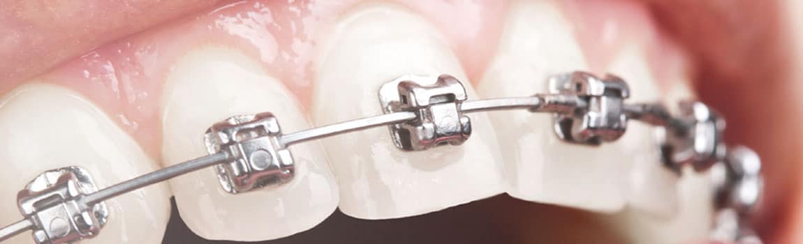 In-Ovation Braces | Brooklyn Orthodontist