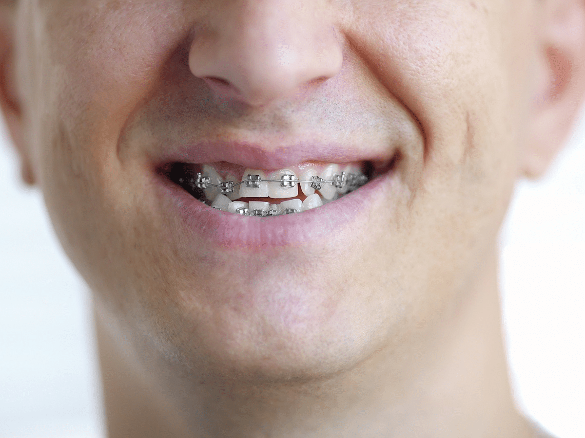 Do Braces Change Your Face? | Hanson Place Orthodontics